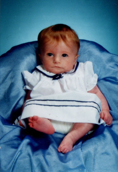 Moebius syndrome - Facial Palsy UK