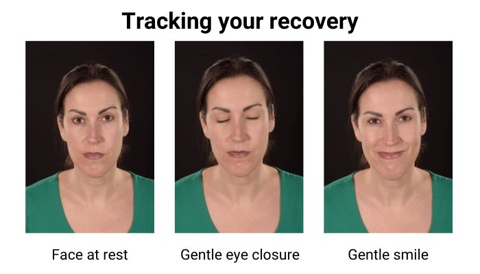 Recording your recovery through photographs - Facial Palsy UK